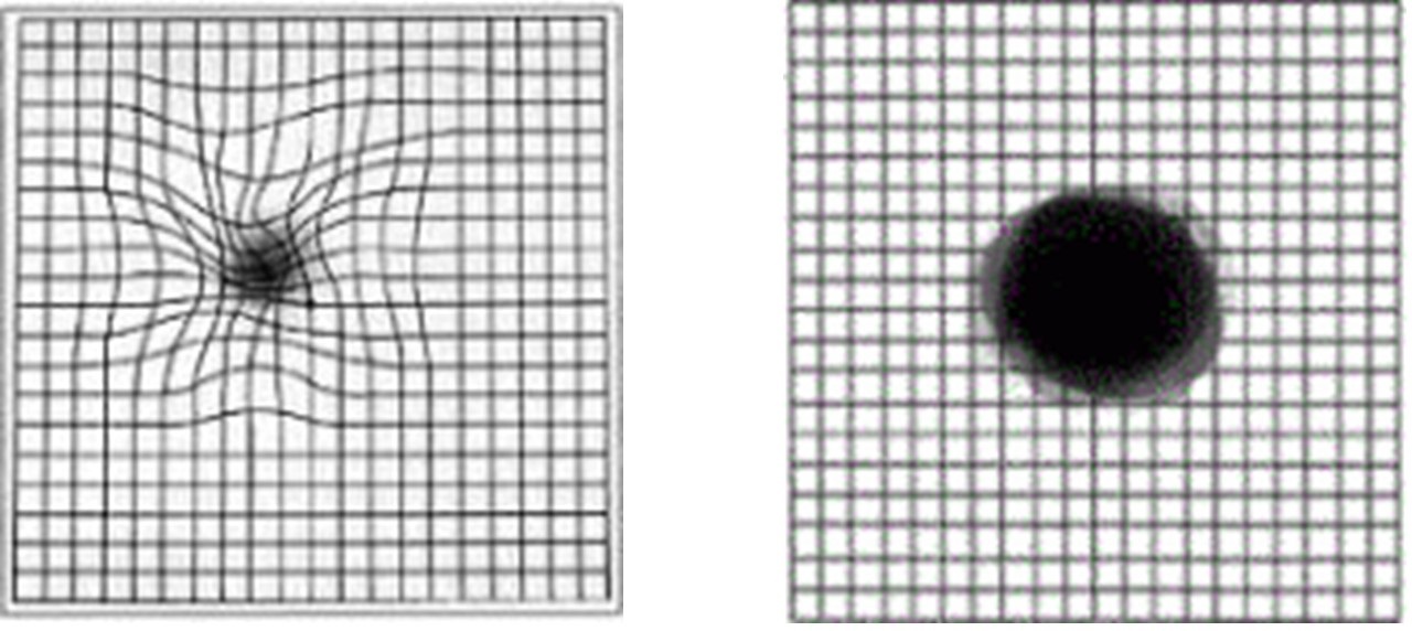 La Dégénérescence Maculaire ou DMLA - Rueil Ma Vision